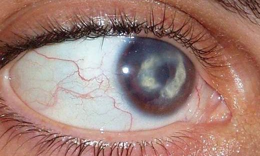 Queratitis - Instituto Oftalmológico - Grupo Recoletas