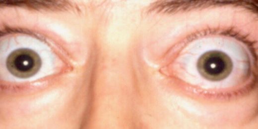 Exoftalmos - Grupo Recoletas