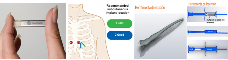 Recoletas Segovia implanta el primer holter subcutáneo de la ciudad ...